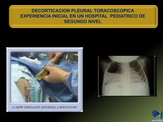 Decorticacion pleural1 | PPTX