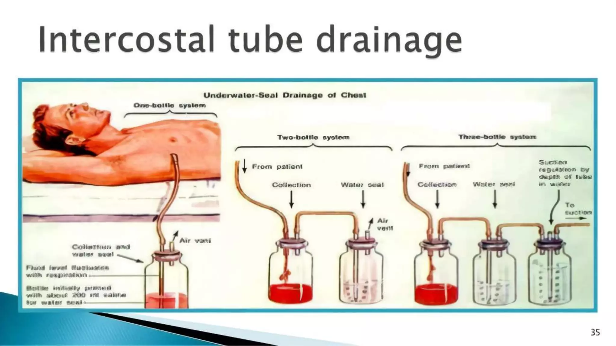 Decortication of the lung.pptx