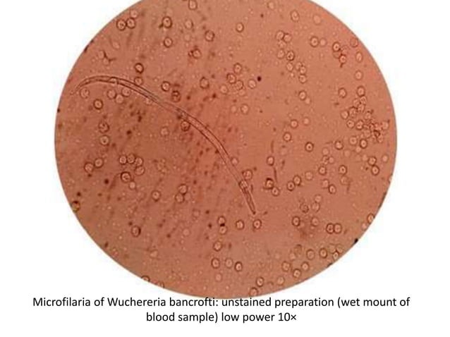 Dec provocation test (lymphatic filiarisis) | PPTX