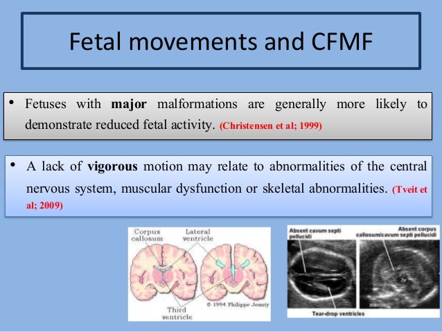 Decreased fetal movements