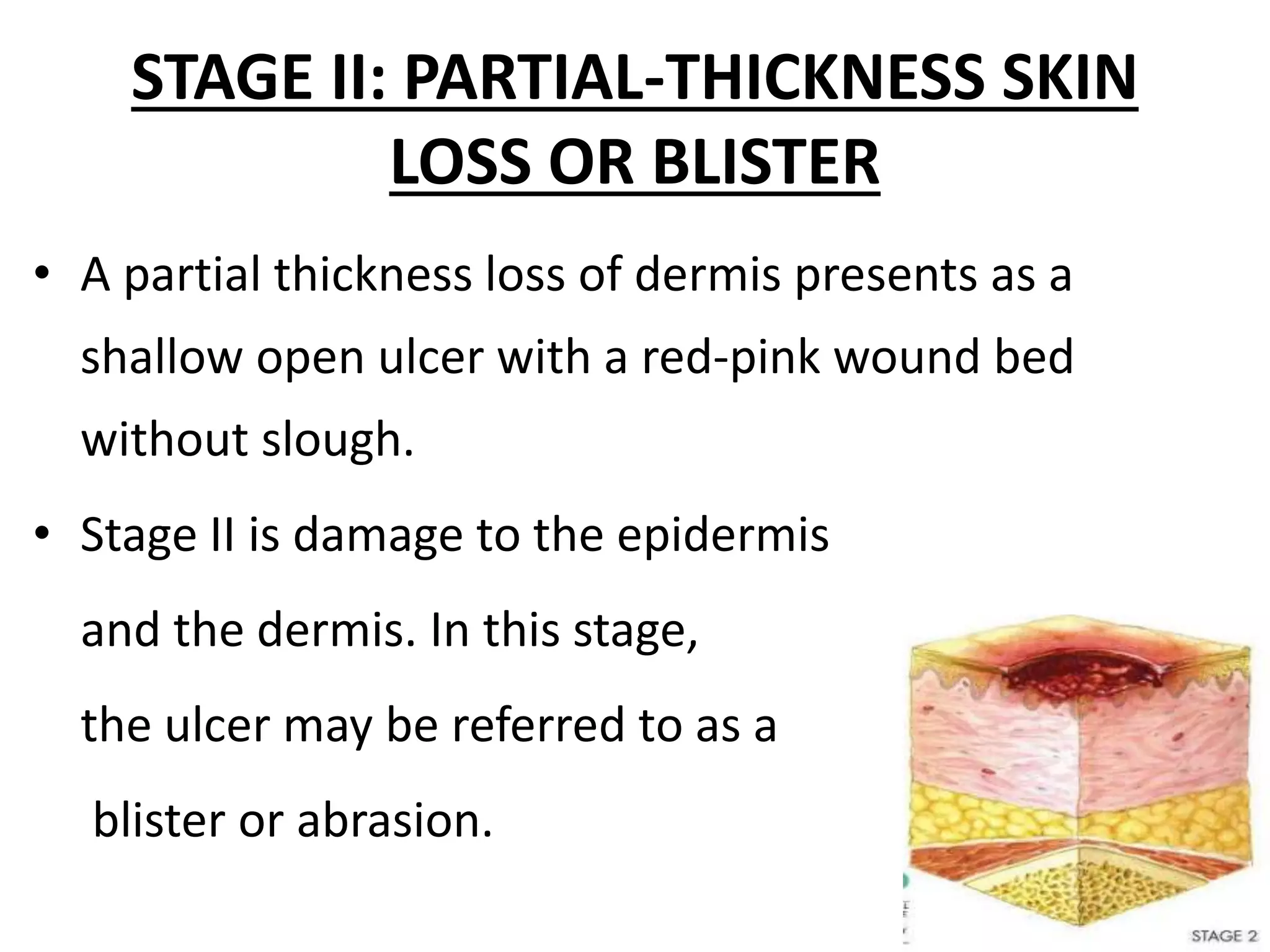 Decubetic ulcer (bed sores) | PPTX