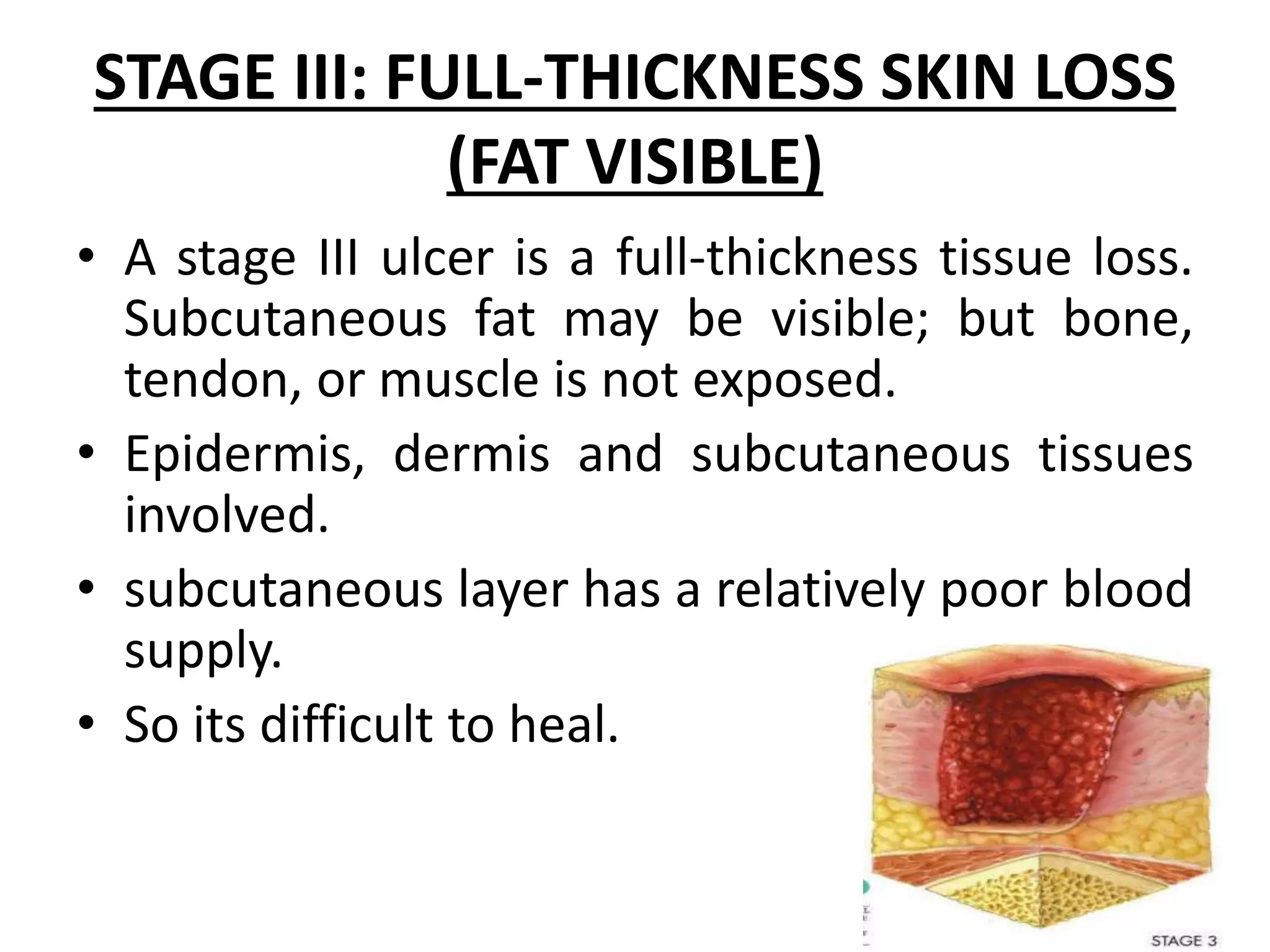Decubetic ulcer (bed sores) | PPTX | Skin and Dermatology | Diseases ...