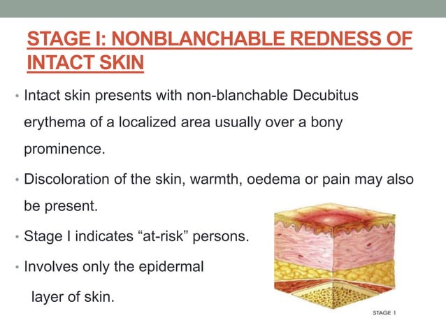 DECUBETIC ULCER (Bed Sores).pptx | Skin and Dermatology | Diseases and ...