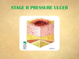 decubital ulcer magement and treatment.pptx