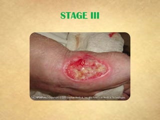decubital ulcer magement and treatment.pptx
