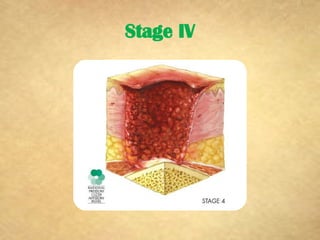 decubital ulcer magement and treatment.pptx