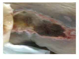 Decubitus dan cara pencegahan decubitus pada pasien | PPT