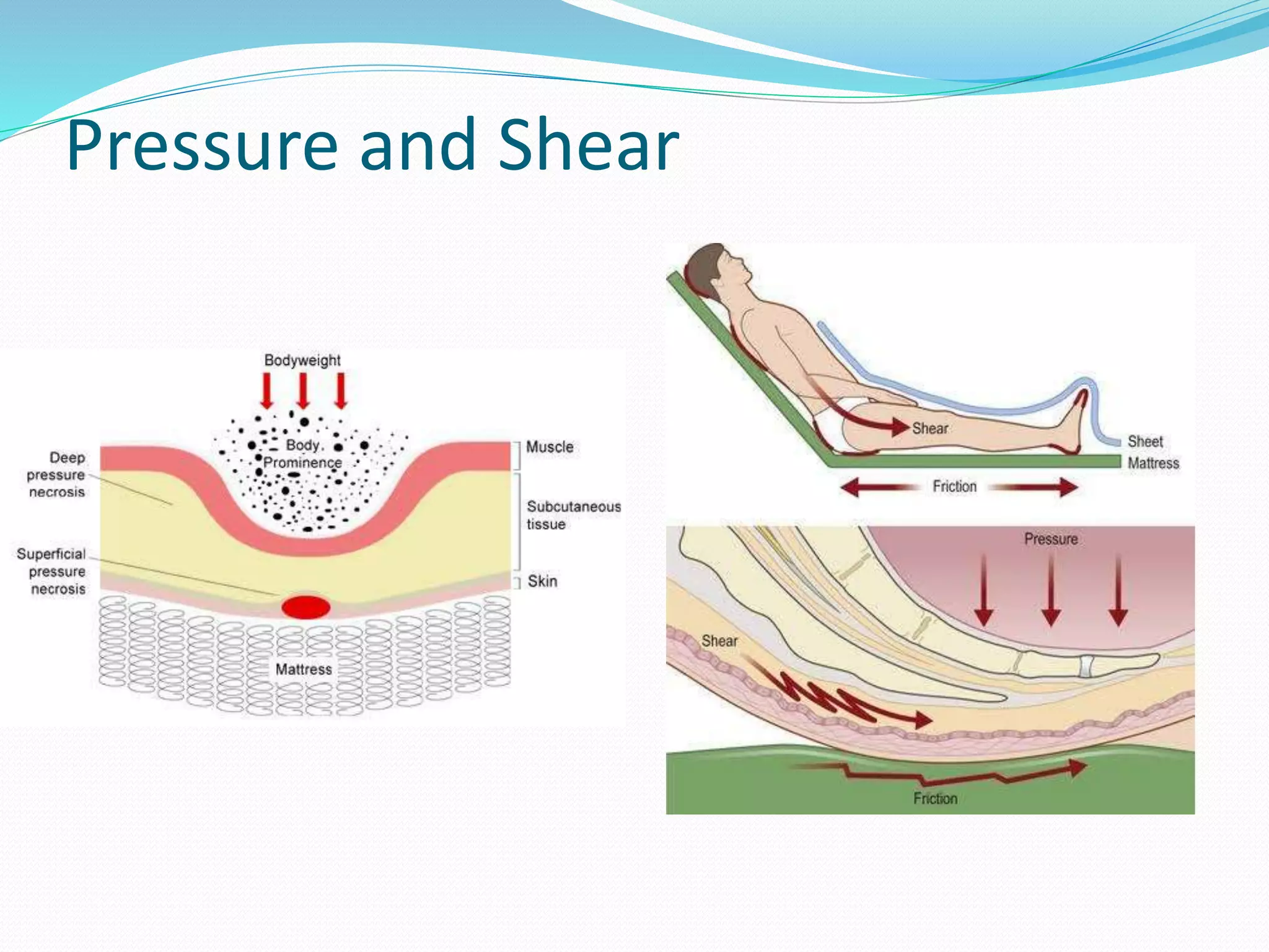 Decubitus ulcer | PPTX