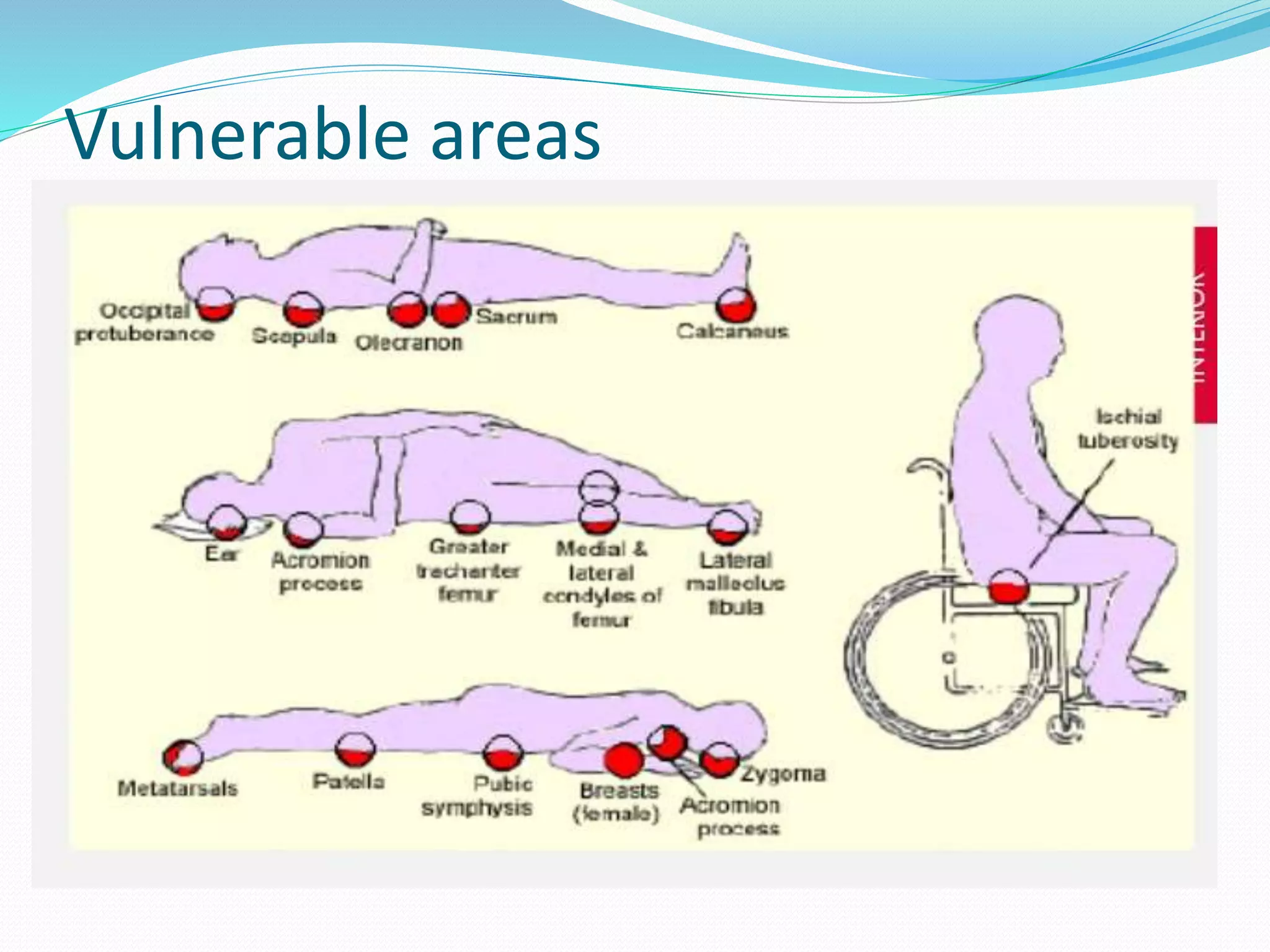 Decubitus ulcer | PPTX