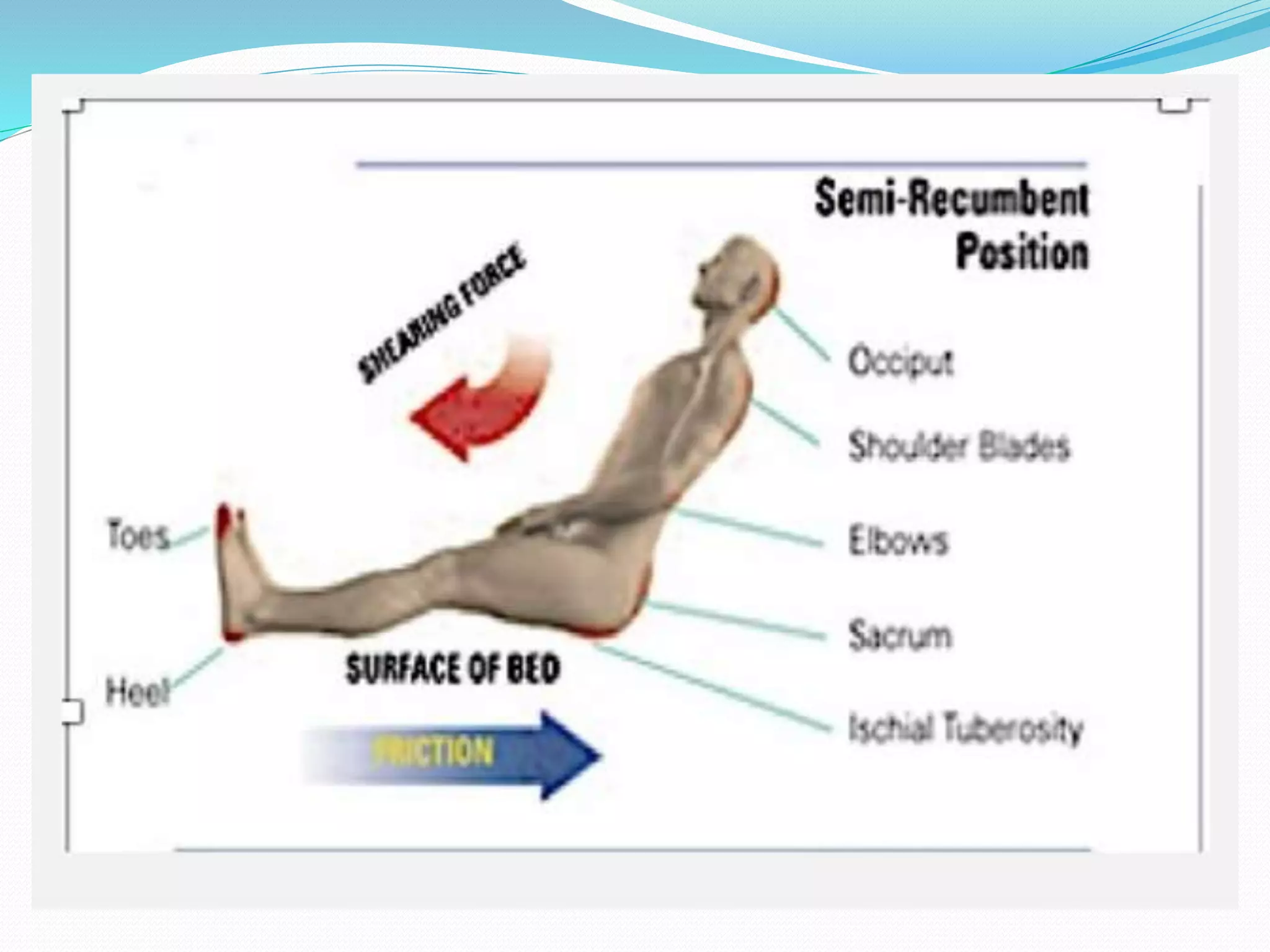 Decubitus ulcer | PPTX