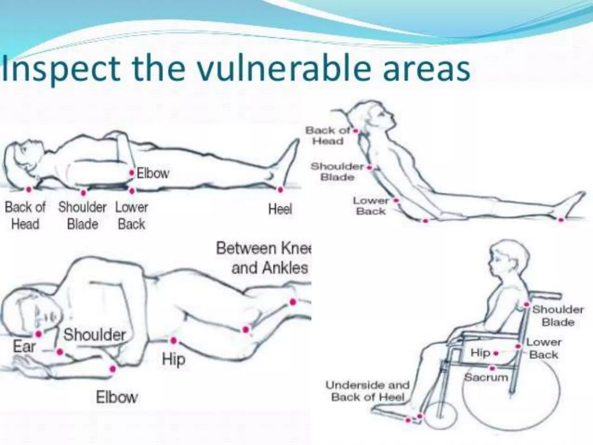 Decubitus ulcer | PPTX