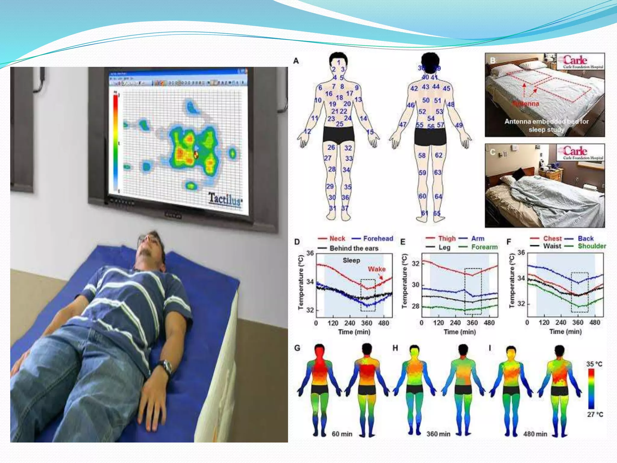Decubitus ulcer | PPTX