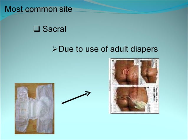 Decubitus ulcers in neurosurgery | PPT