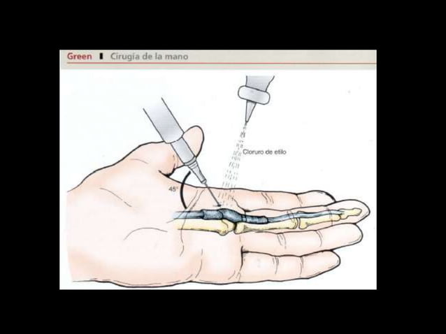 Dedo en gatillo | PPT