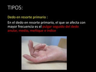 Dedo en gatillo | PPTX