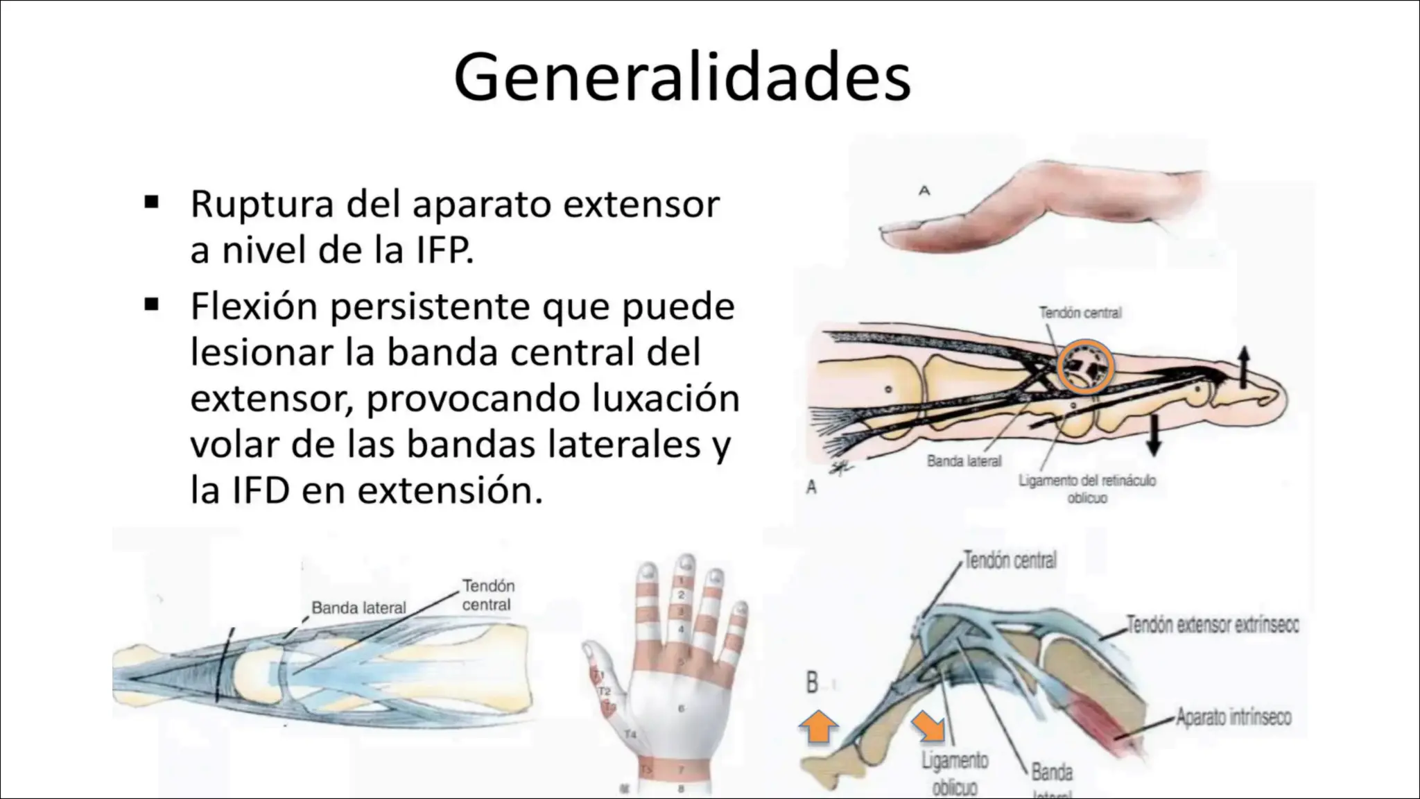 Dedo con deformidad en ojal o “boutonnière” | PDF | Death, Injury, or ...
