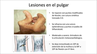 Dedo con deformidad en ojal o “boutonnière” | PDF