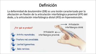 Dedo con deformidad en ojal o “boutonnière” | PDF