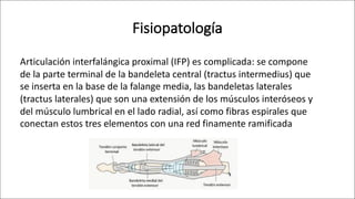 Dedo con deformidad en ojal o “boutonnière” | PDF