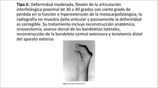 Dedo con deformidad en ojal o “boutonnière” | PDF