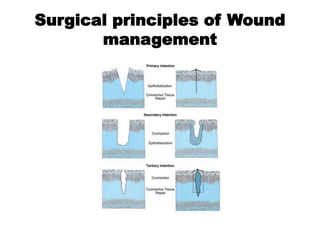 Wound healing and management of wound in surgery | PPT