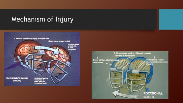 sports related head injury (concussion) | PPTX | Death, Injury, or ...