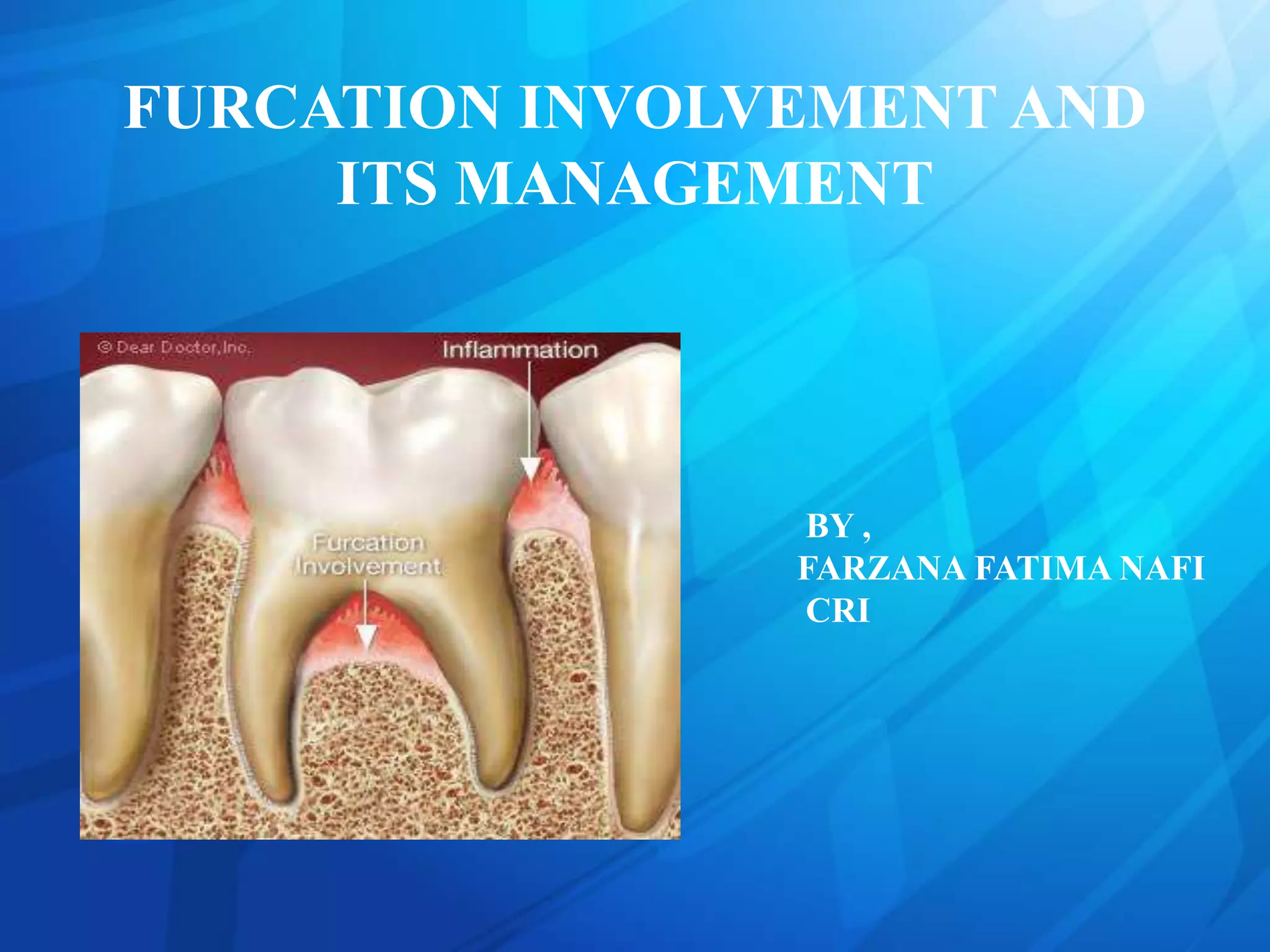 FURCATION INVOLVEMENT AND ITS MANAGEMENT | PPT