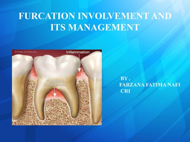 FURCATION INVOLVEMENT AND ITS MANAGEMENT | PPT | Dental Health ...