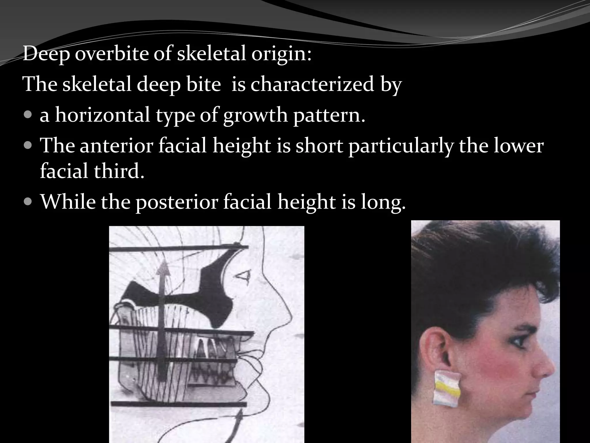 orthodontic deep bite | PPT | Dental Health | Diseases and Conditions