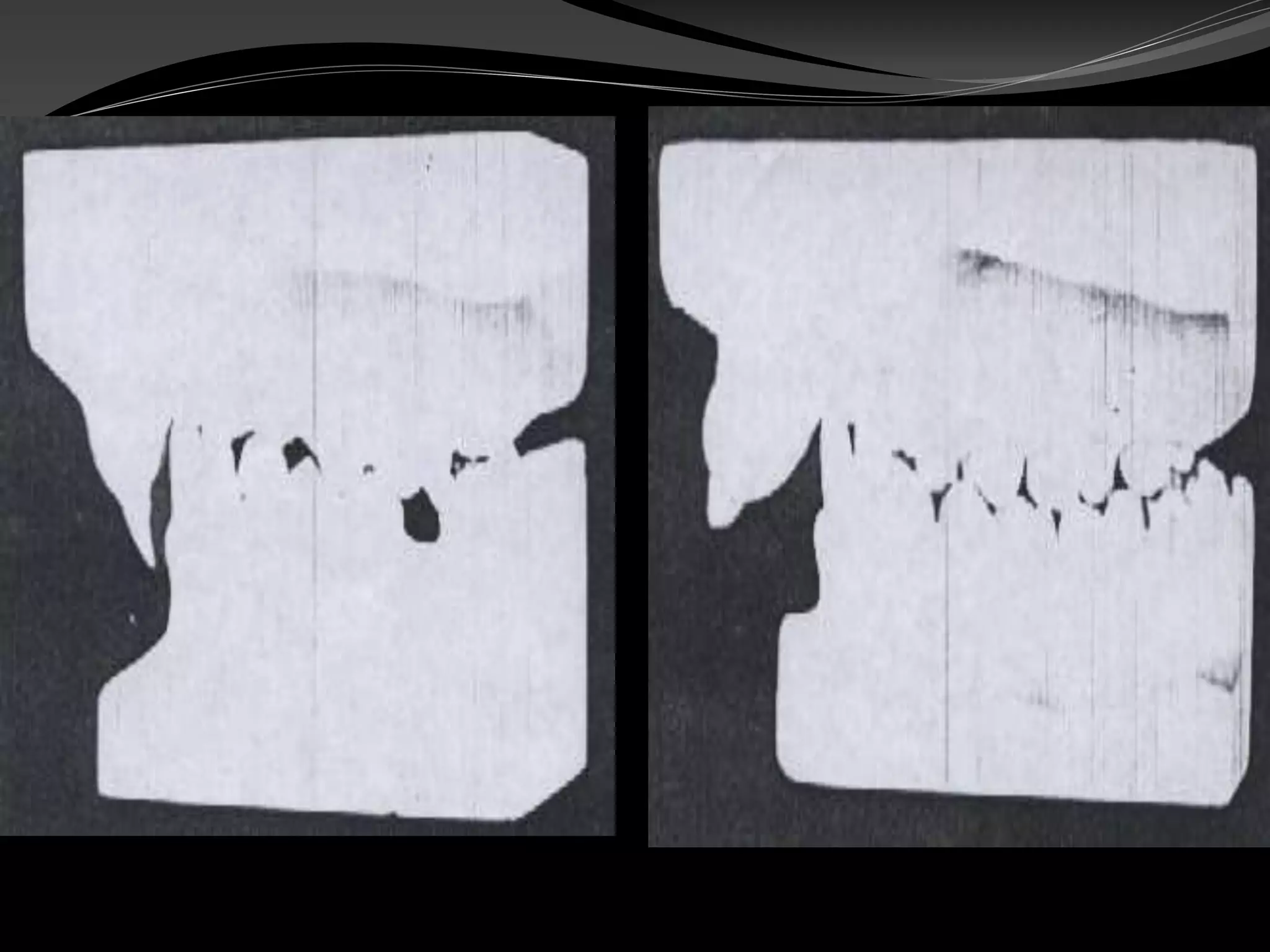 orthodontic deep bite | PPT | Dental Health | Diseases and Conditions