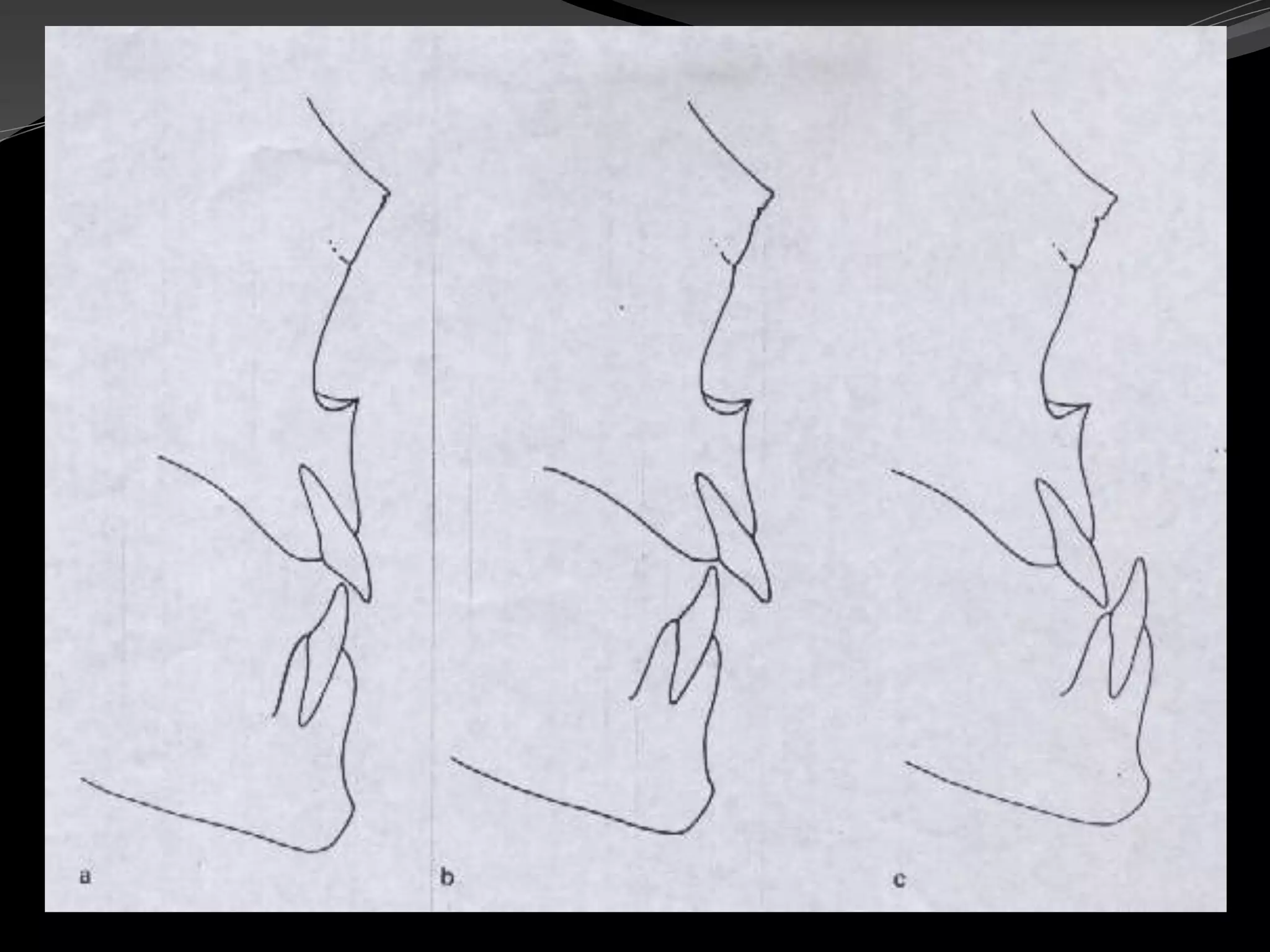 orthodontic deep bite | PPT | Dental Health | Diseases and Conditions