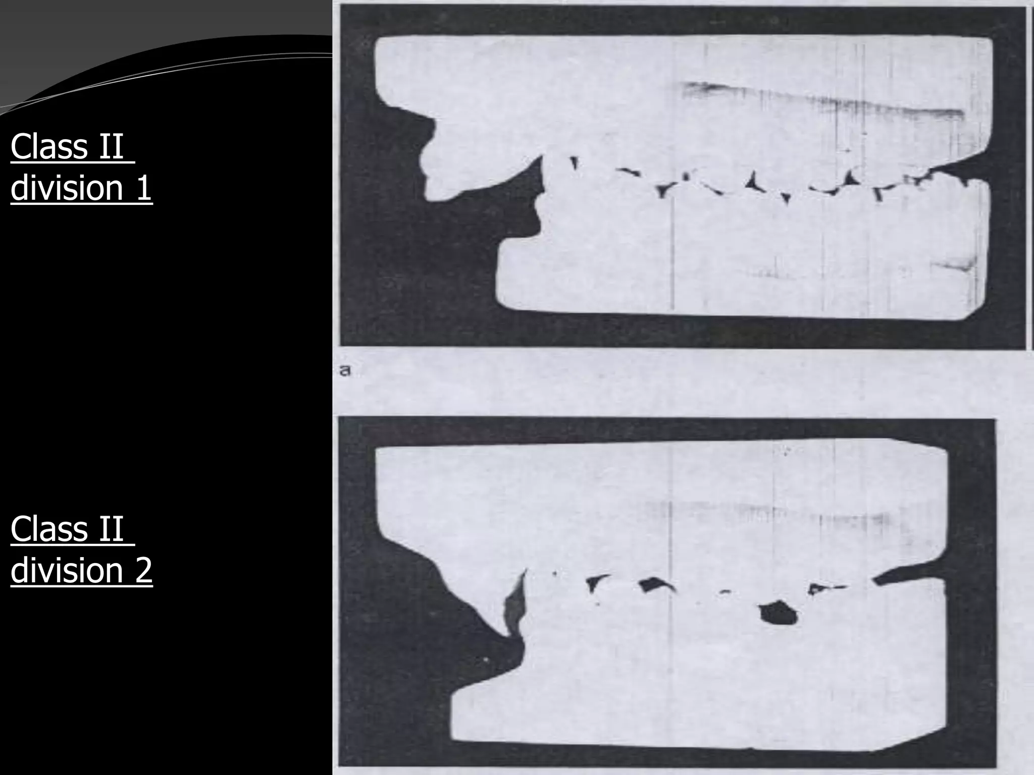 orthodontic deep bite | PPT | Dental Health | Diseases and Conditions