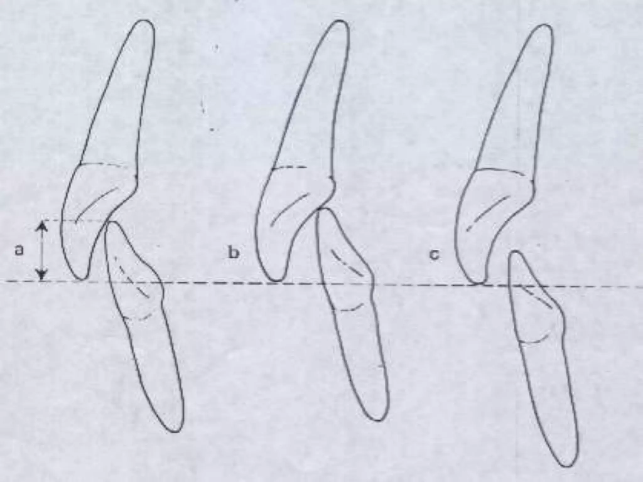orthodontic deep bite | PPT | Dental Health | Diseases and Conditions