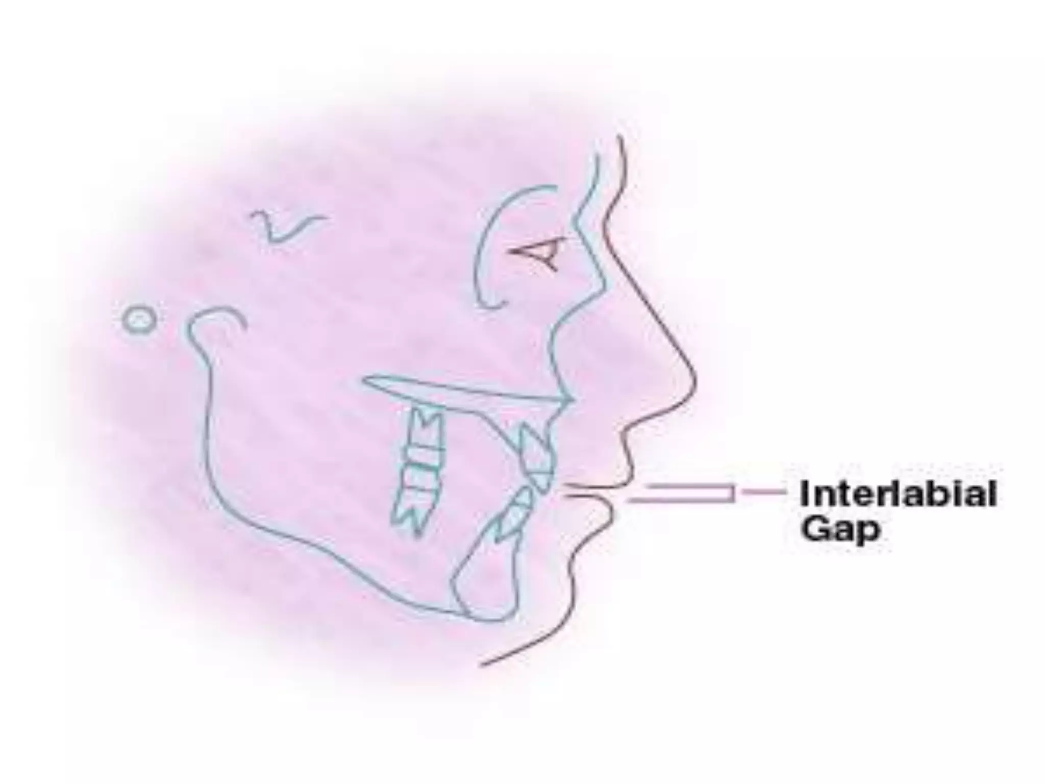 orthodontic deep bite | PPT | Dental Health | Diseases and Conditions