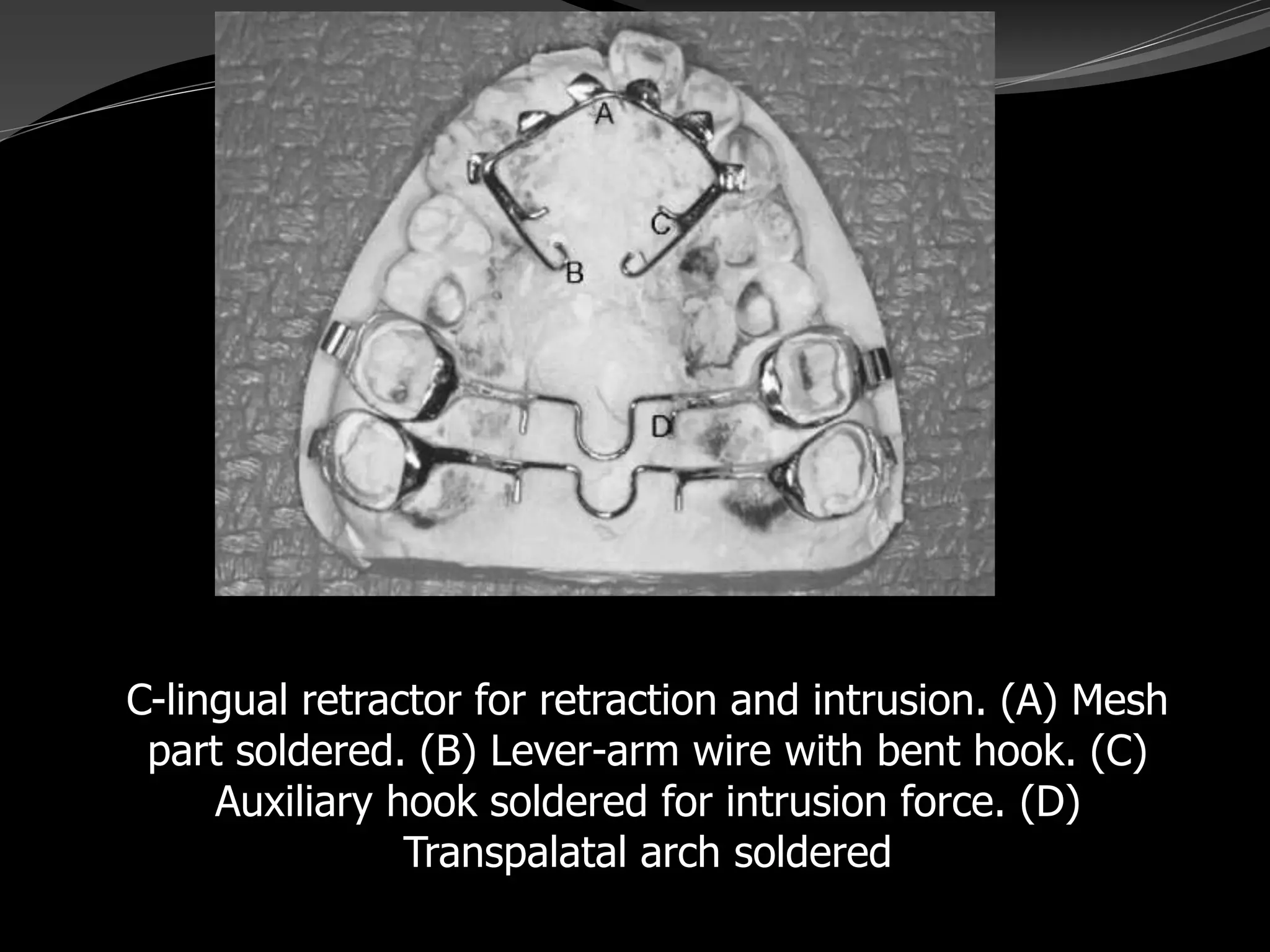 orthodontic deep bite | PPT