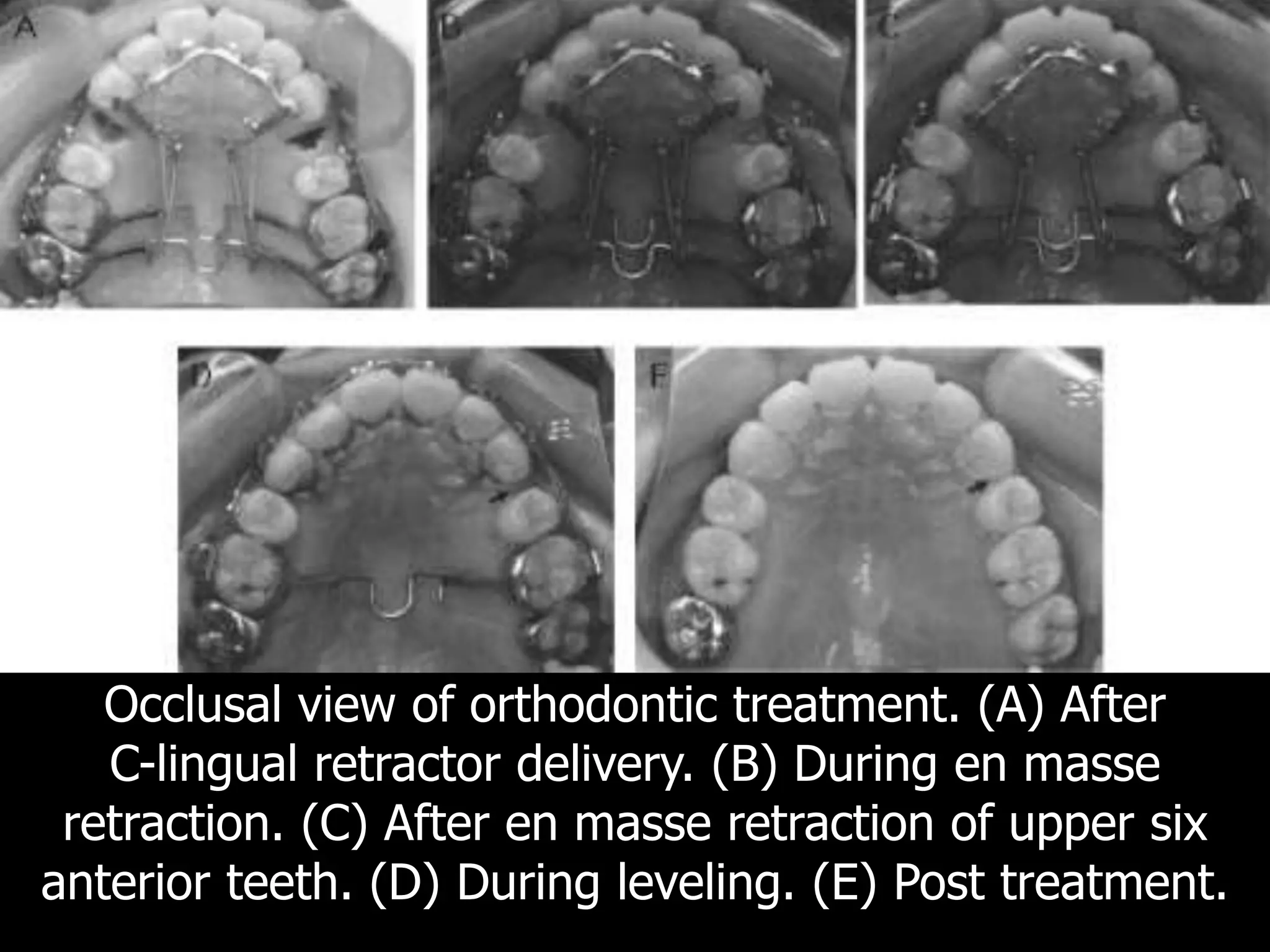 orthodontic deep bite | PPT