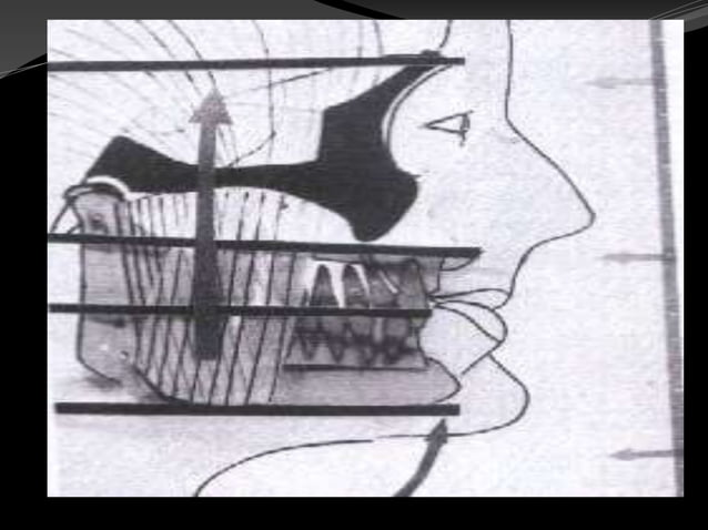 orthodontic deep bite | PPT | Dental Health | Diseases and Conditions