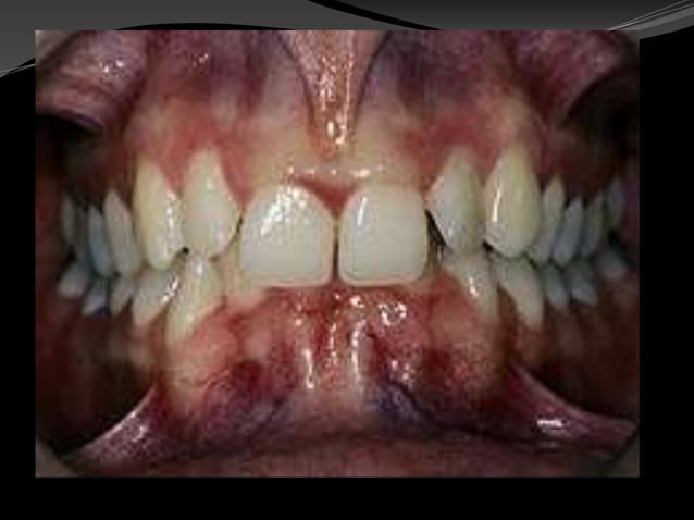 orthodontic deep bite | PPT | Dental Health | Diseases and Conditions