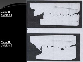 orthodontic deep bite | PPT