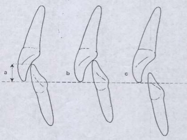 orthodontic deep bite | PPT | Dental Health | Diseases and Conditions