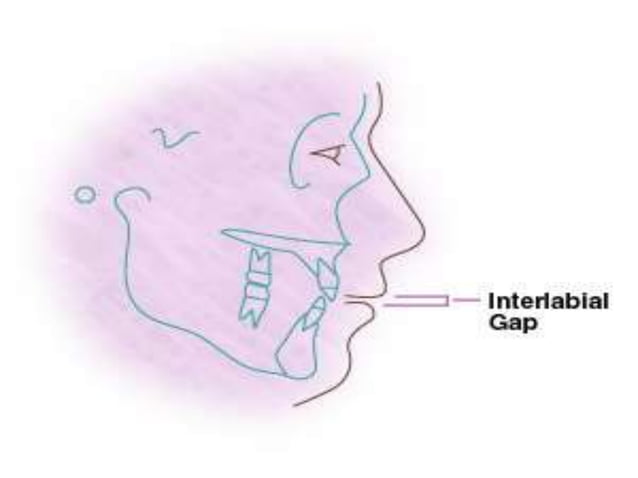 orthodontic deep bite | PPT | Dental Health | Diseases and Conditions