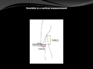 orthodontic deep bite | PPT