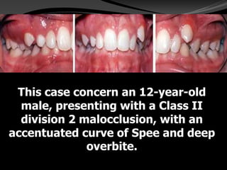 orthodontic deep bite | PPT