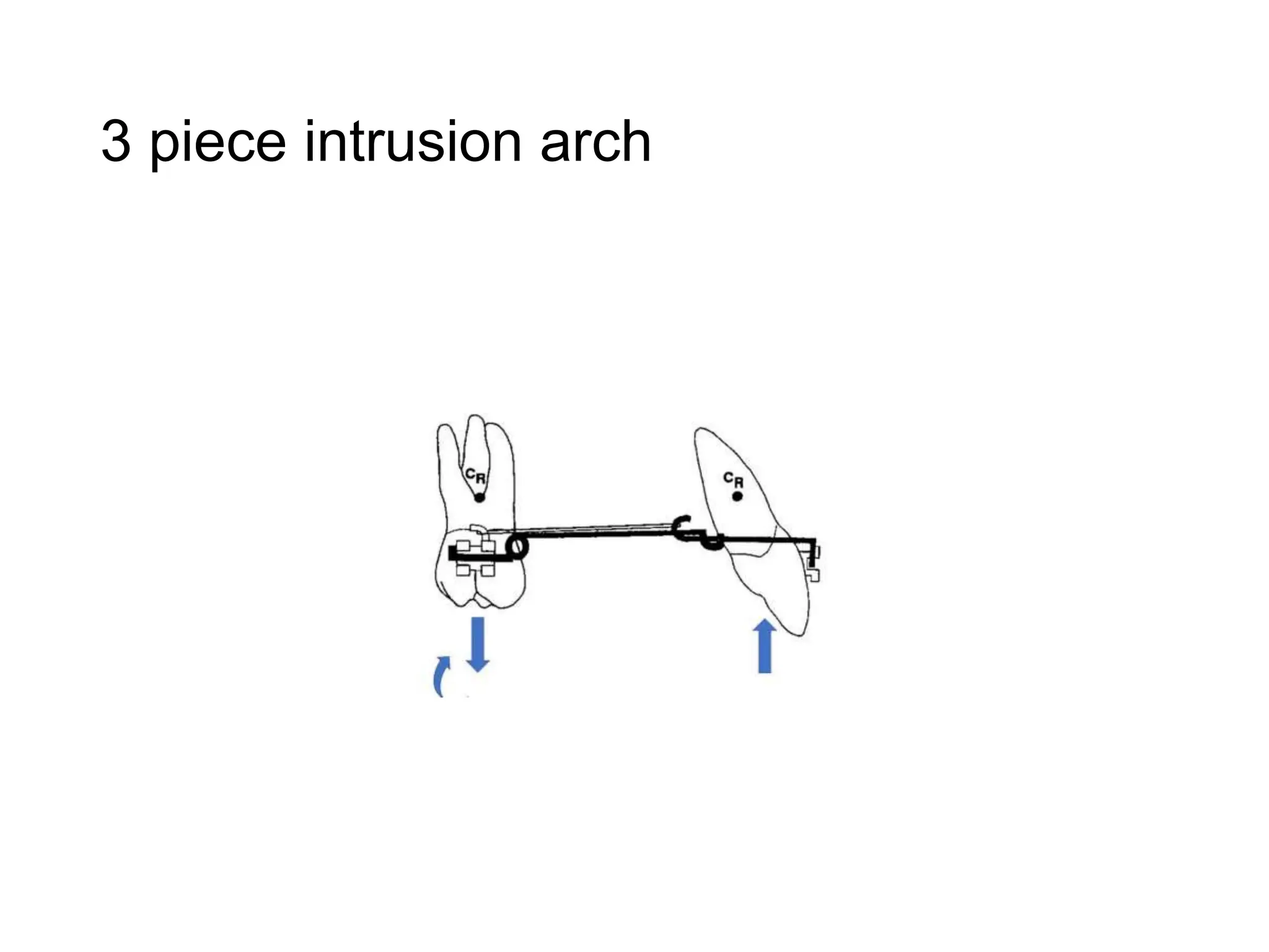 DEEP BITE..RX.ppt, orthodontic extractions | PPT