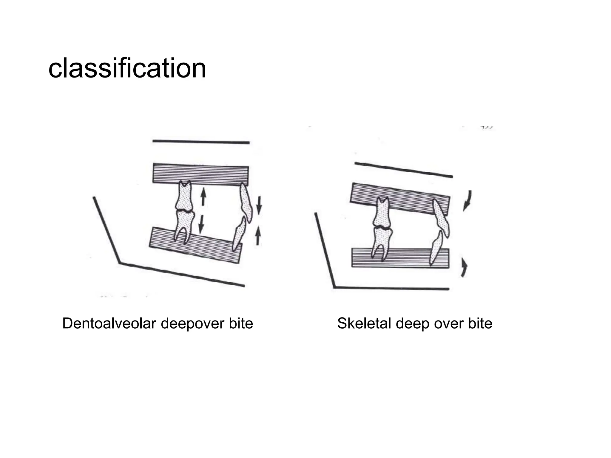 DEEP BITE..RX.ppt, orthodontic extractions | PPT
