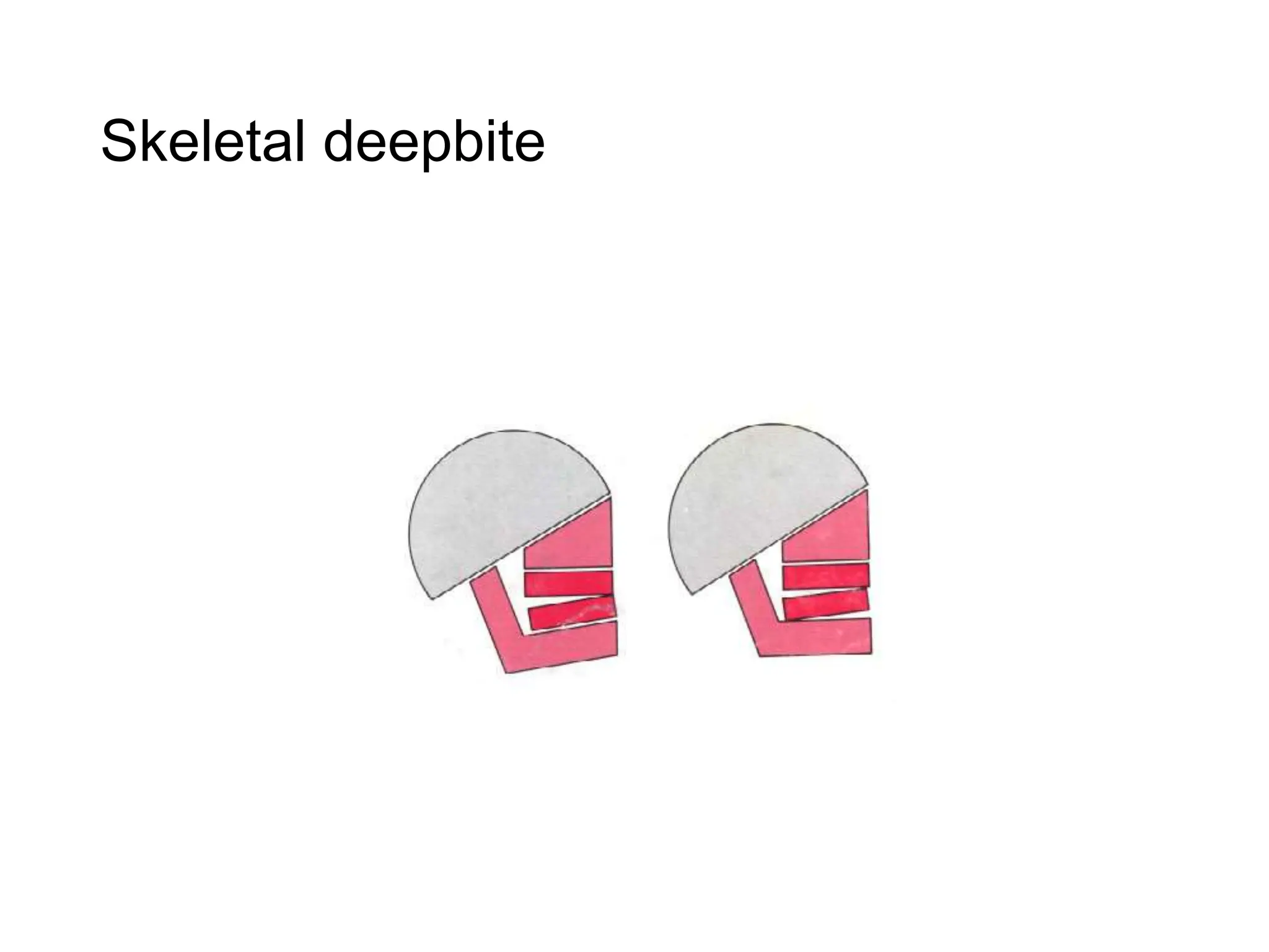 DEEP BITE..RX.ppt, orthodontic extractions | PPT