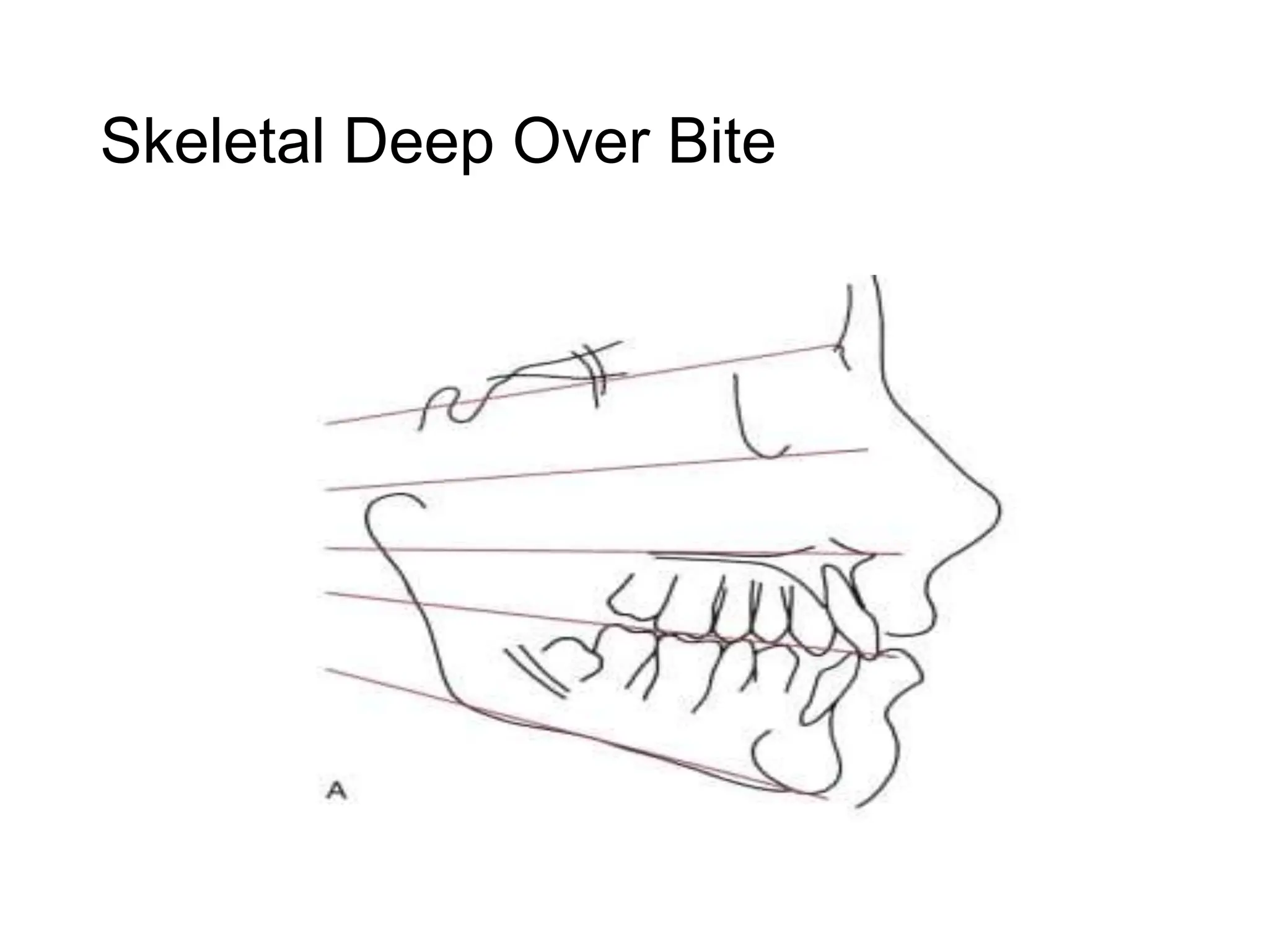 DEEP BITE..RX.ppt, orthodontic extractions | PPT