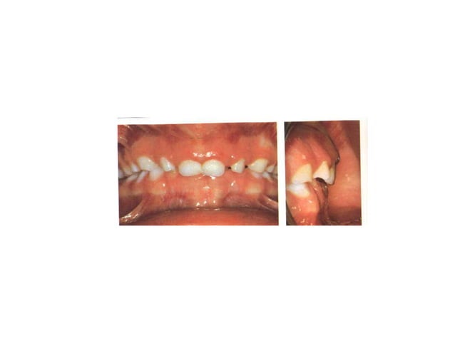 DEEP BITE..RX.ppt, orthodontic extractions | PPT