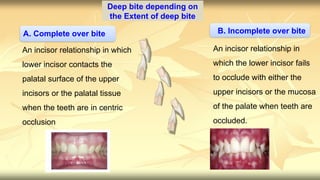 Deep bite.pptx over bite Deep bite.pptx over bite | PPT