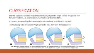DEEP BITE \ VERTICAL PLANE DISCREPANCIES .pptx